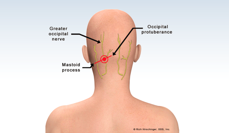 Occipital Nerve Blocks in Southlake, TX | Texas TMJ Sleep & Facial Pain